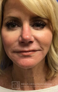 Profound RF in Atlanta, GA | Arslanian Plastic Surgery